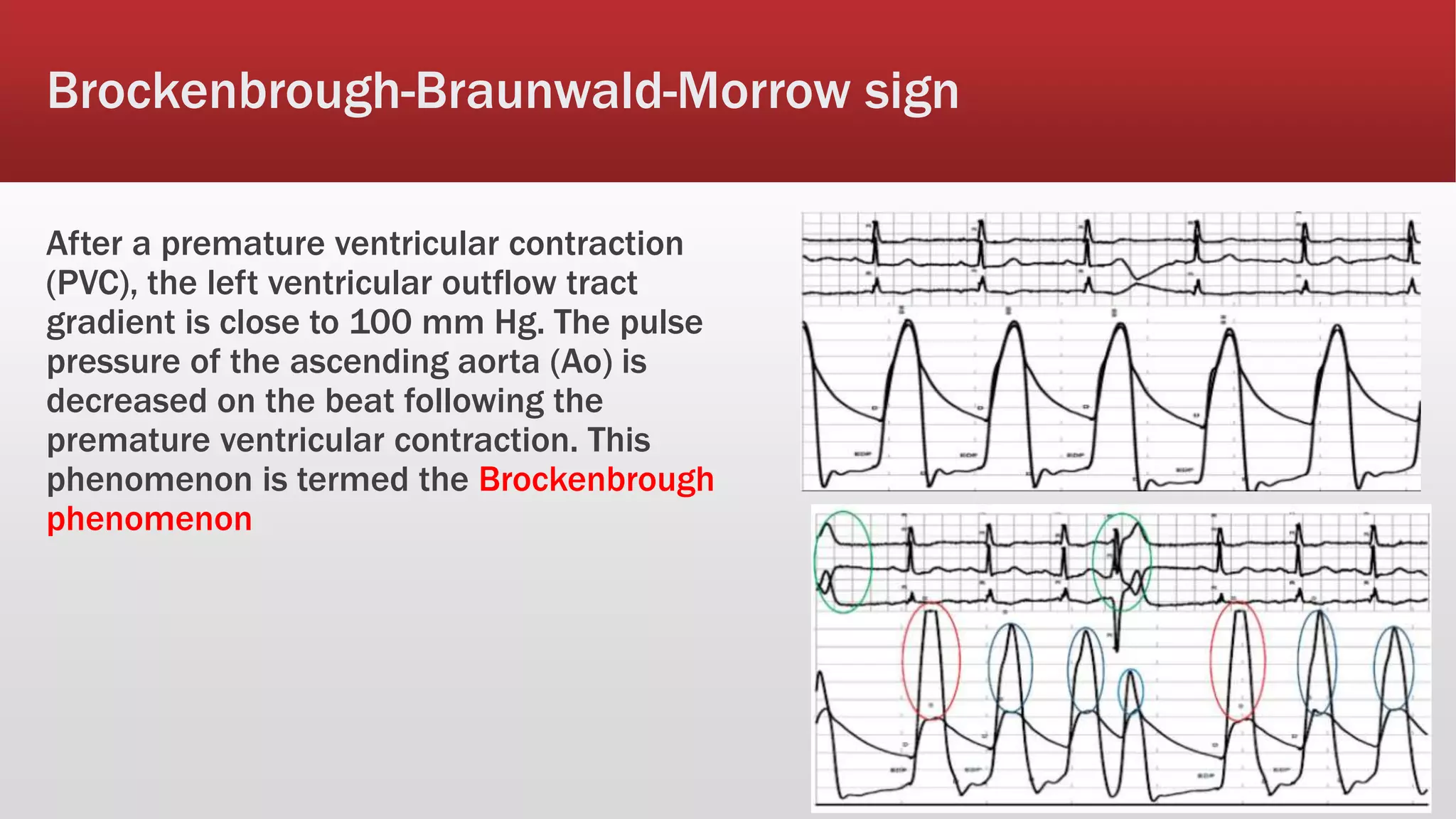 HCM Hypertrophic cardiomyopathy.pptx