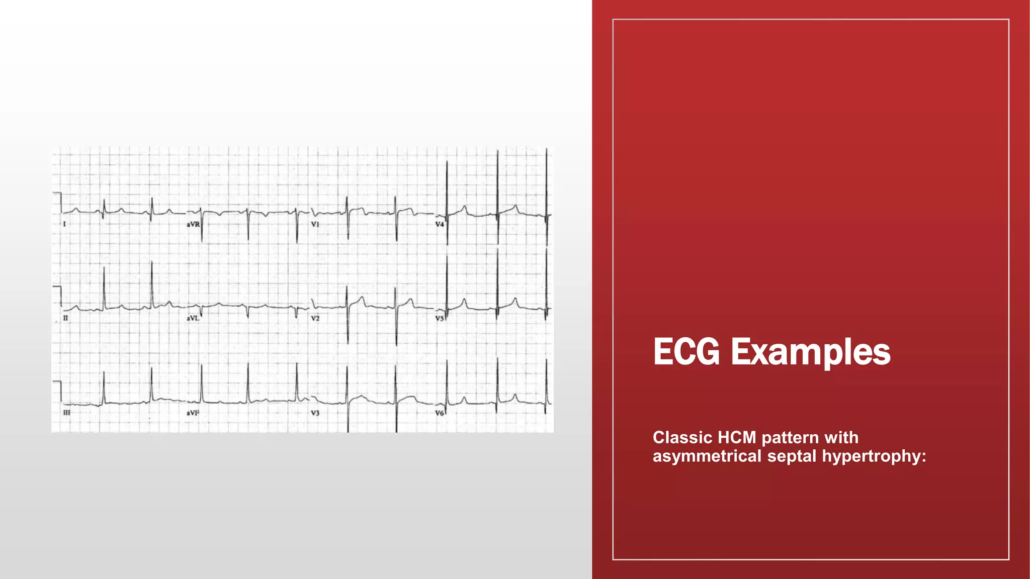 HCM Hypertrophic cardiomyopathy.pptx