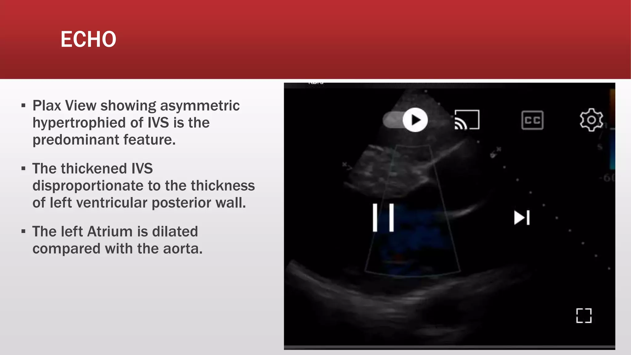 HCM Hypertrophic cardiomyopathy.pptx