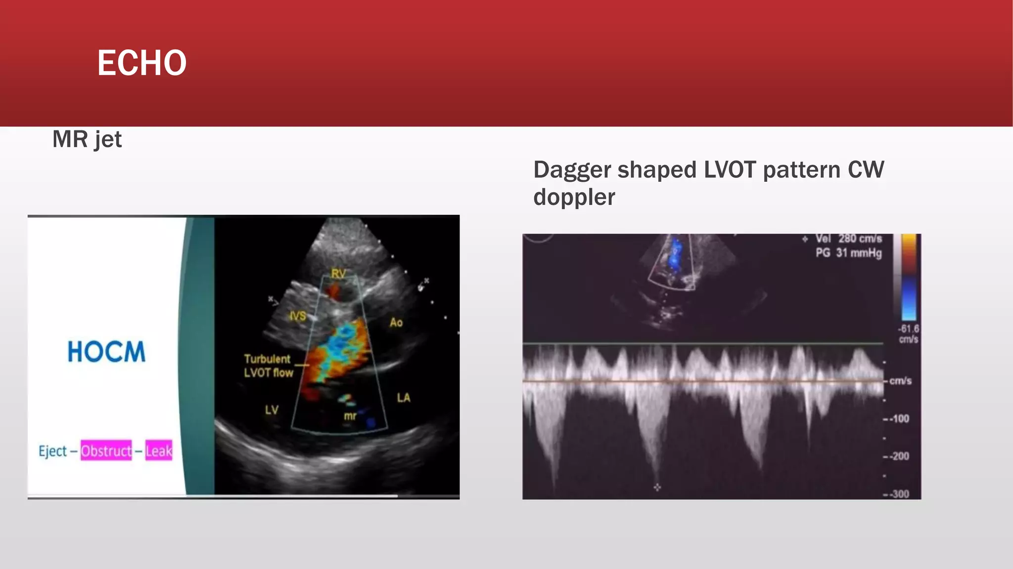 HCM Hypertrophic cardiomyopathy.pptx