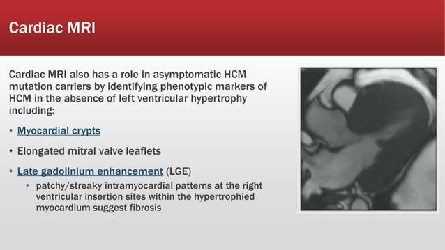 HCM Hypertrophic cardiomyopathy.pptx