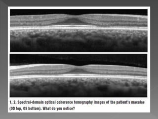Hcq ocular toxicity | PPTX