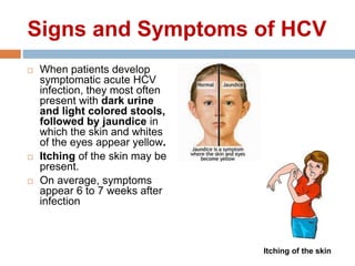 Basics of Hepatitis C | PPTX