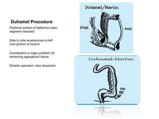Hirchsprang's disease | PPT