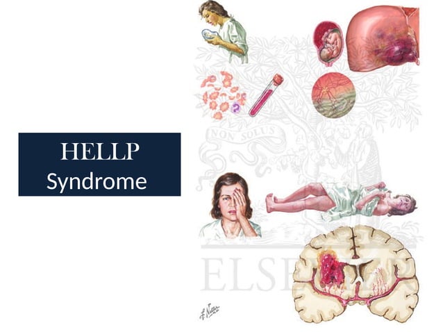 Hypertensive disorders in pregnancy by Dr. Ranjana | PPT | Free Download