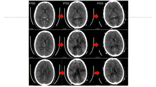 Physiologic targets for Traumatic Brain Injury in neuro-critical Care | PDF
