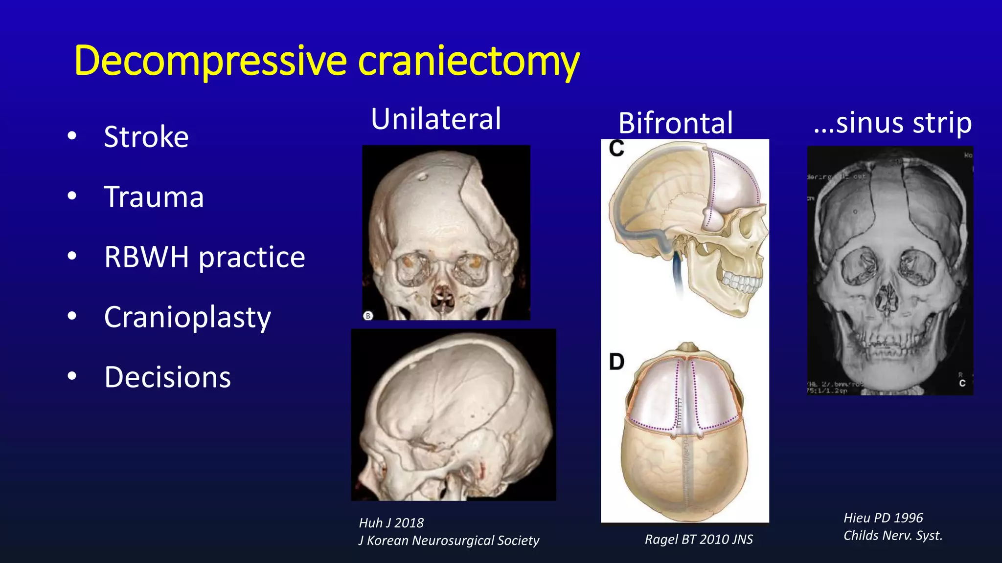 Lifting the lid on decompressive craniectomy by Associate Professor ...