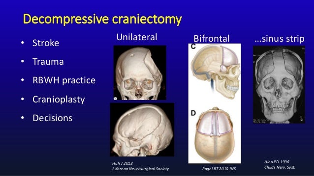Lifting the lid on decompressive craniectomy by Associate Professor L…