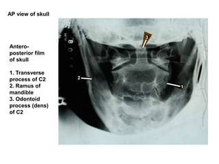 head-and-neck-radiographs.ppt for Ent residents | PPT