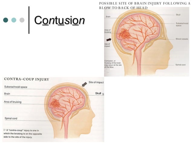 Head Injuries & Concussion | PPT