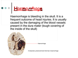 Head Injuries & Concussion | PPT