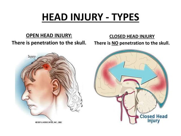 Head injuries