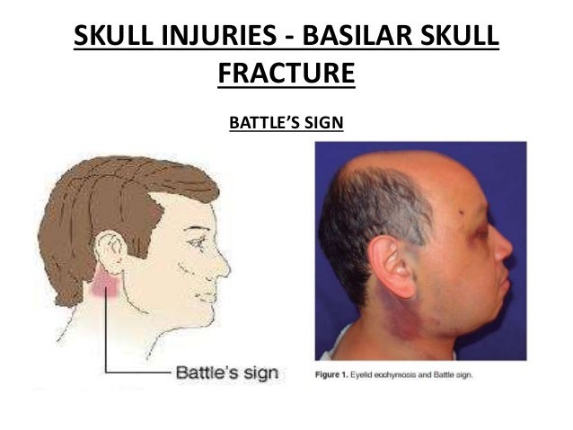 Head injuries