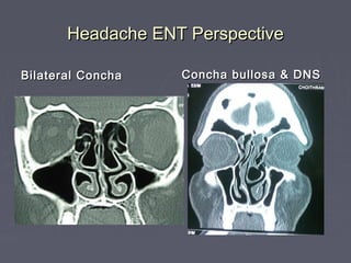 Headache ent perspective | PPT