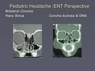 Headache ent perspective | PPT