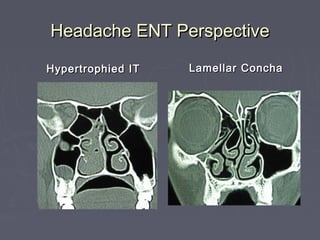 Headache ent perspective | PPT