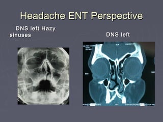Headache ent perspective | PPT