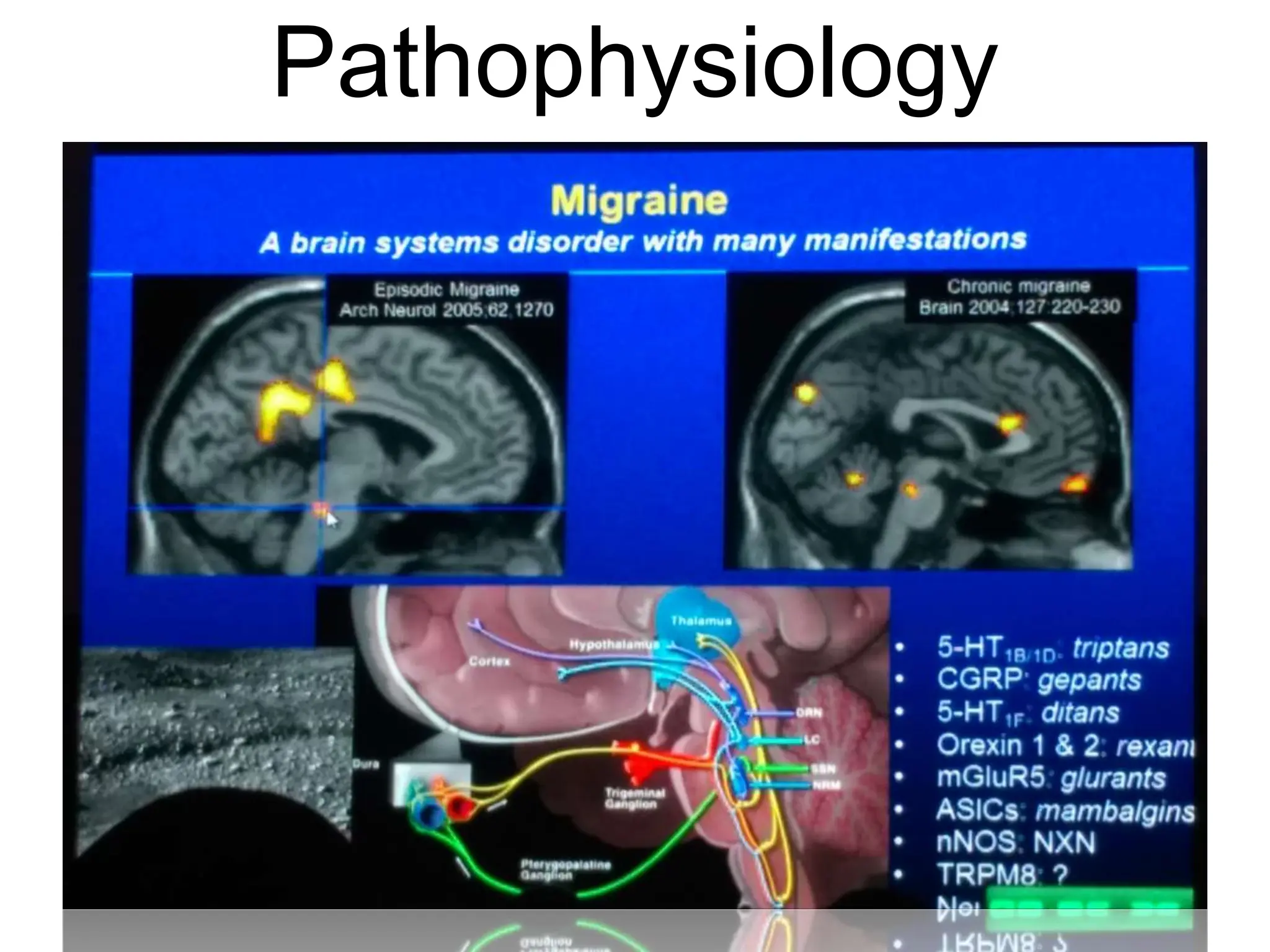 Headache and it's type with pathophysiology and treatment | PPTX