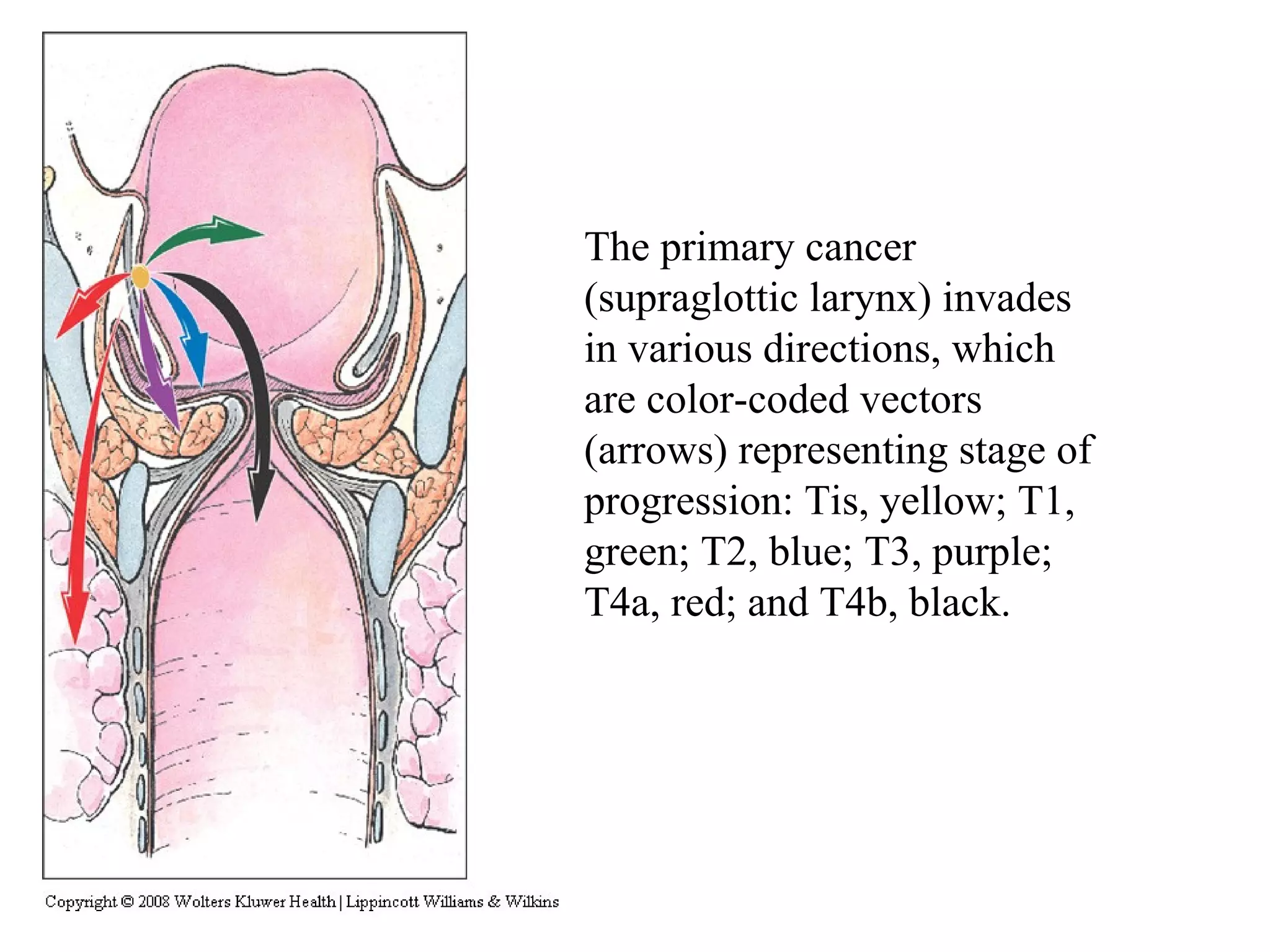 Head And Neck Cancer | PPT
