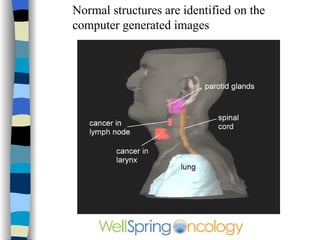 Head And Neck Cancer | PPT