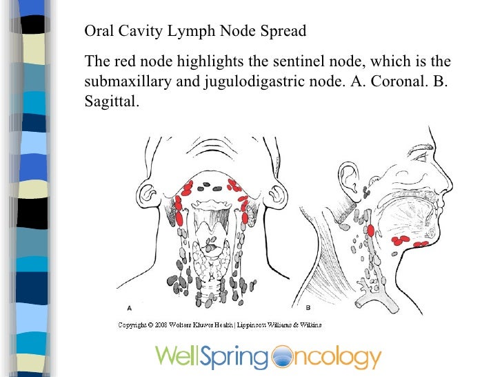 Head And Neck Cancer