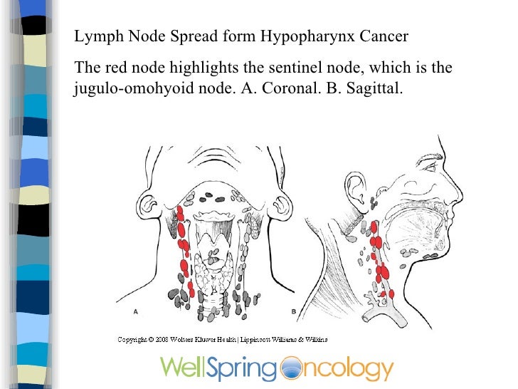 Cancer Neck Lymph Nodes Diagram