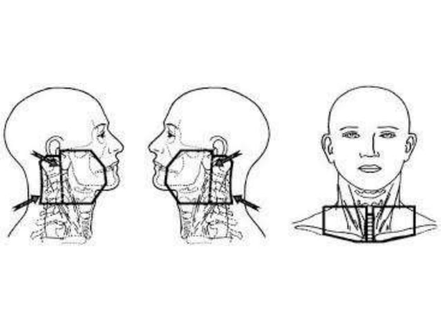 Head And Neck Cancer Ppt