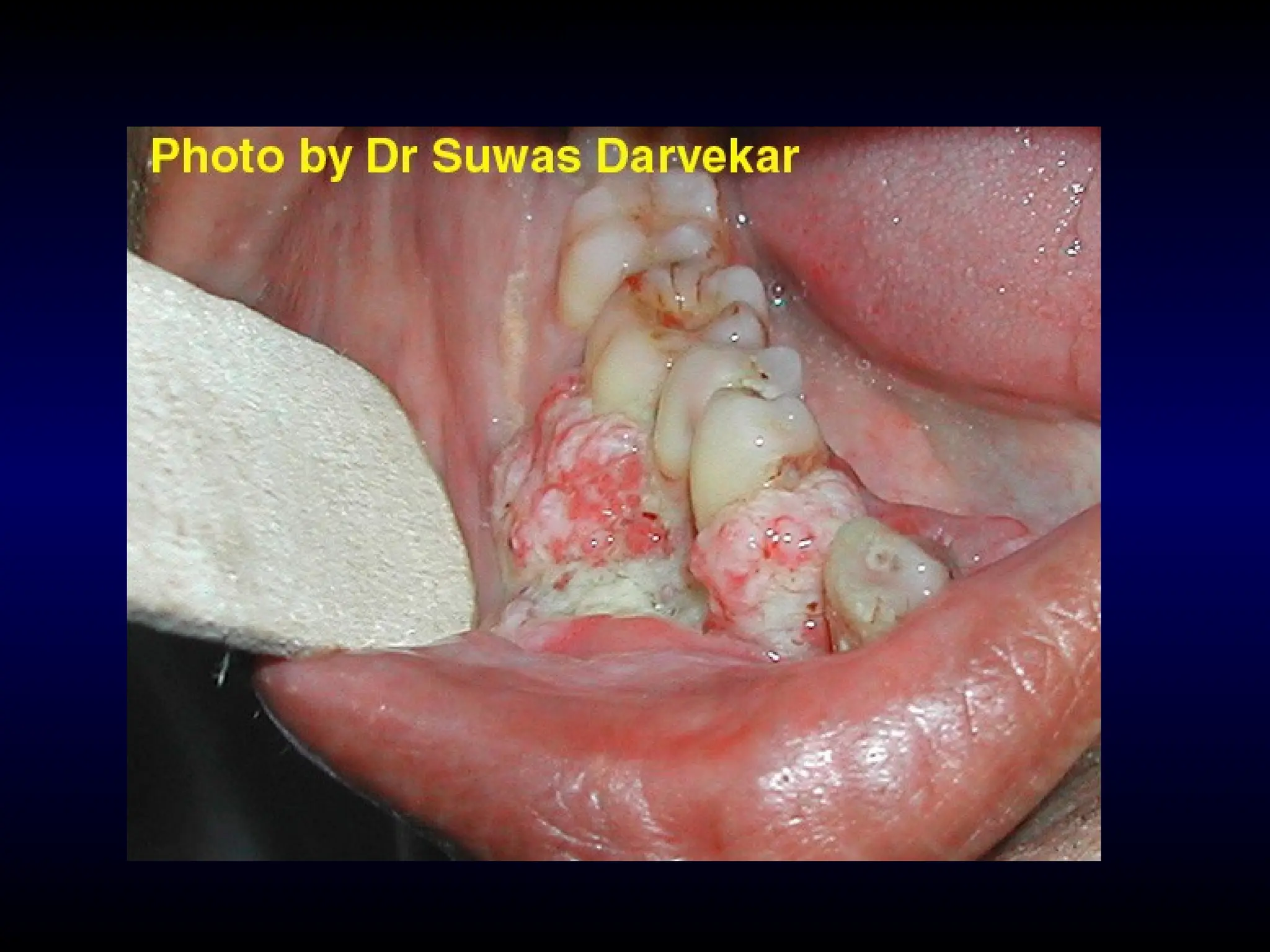 Head and Neck cancer for medical student.ppt