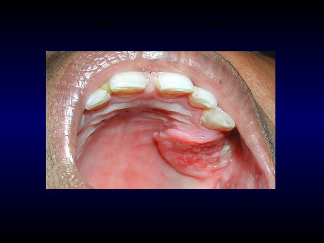 Head and Neck cancer for medical student.ppt