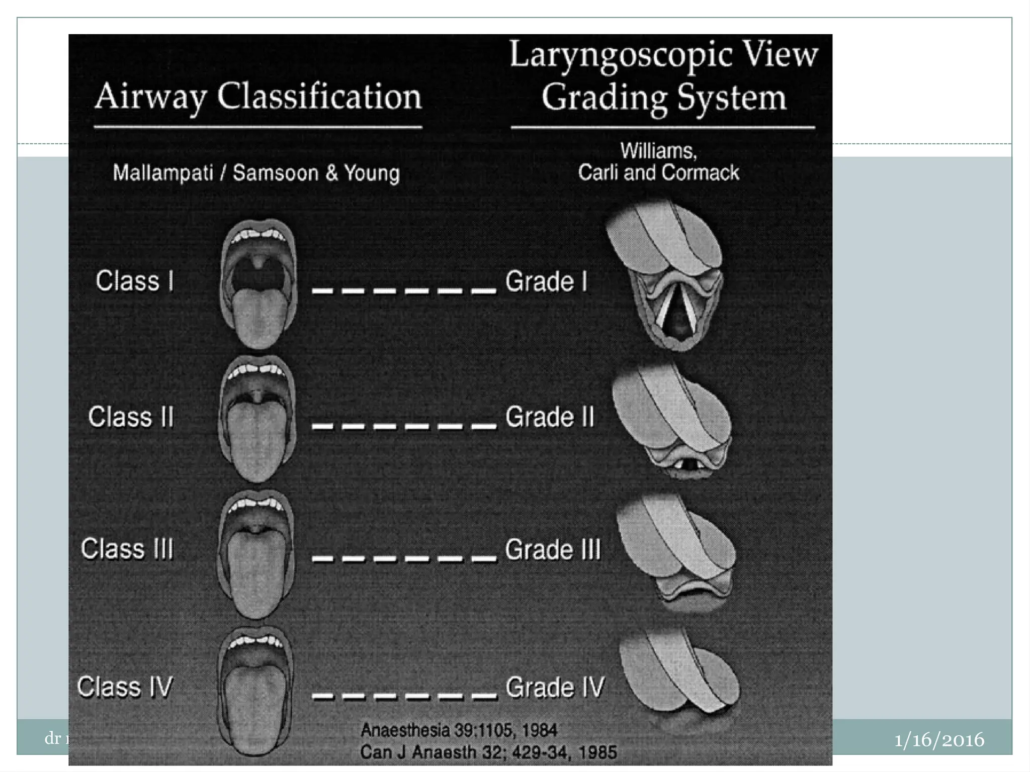 Head and Neck cancer surgery anesthesia considerations.pptx