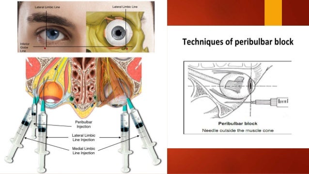 Nerve Blocks in Head and Neck