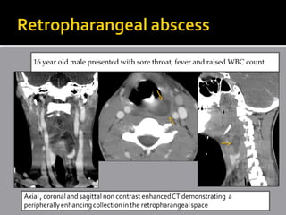Peritonsillar Abscess X Ray