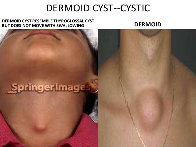 Dermoid Cyst Neck