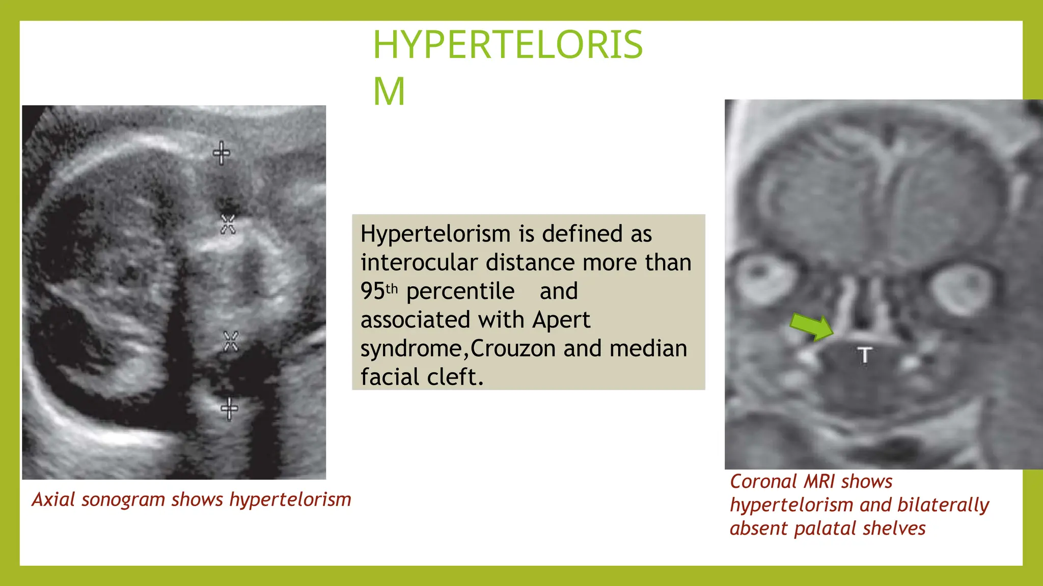 head and neck masses power point presentation | PPTX