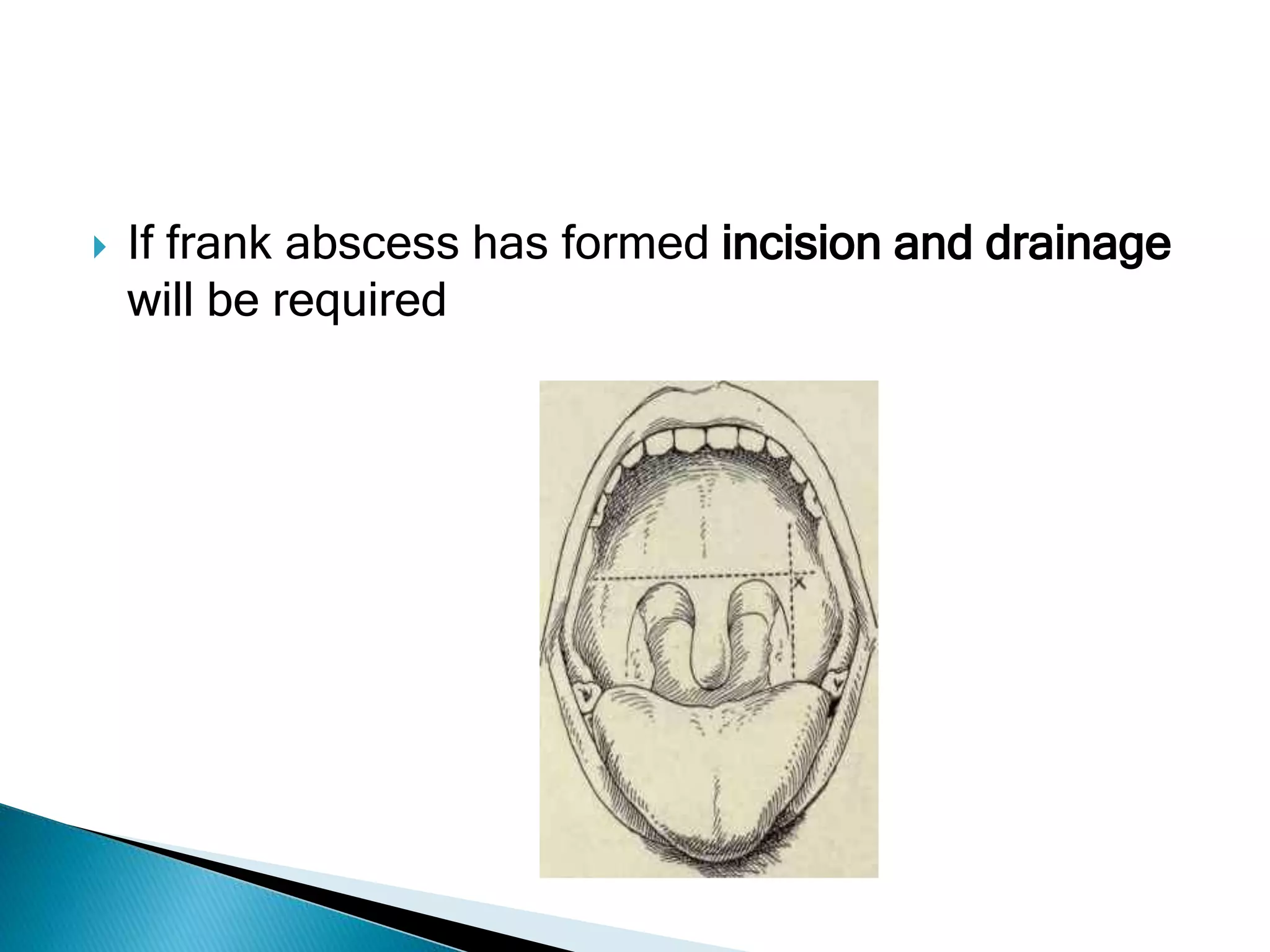 Head and neck space infections 22 8-2016,dr.bini mohan | PPTX