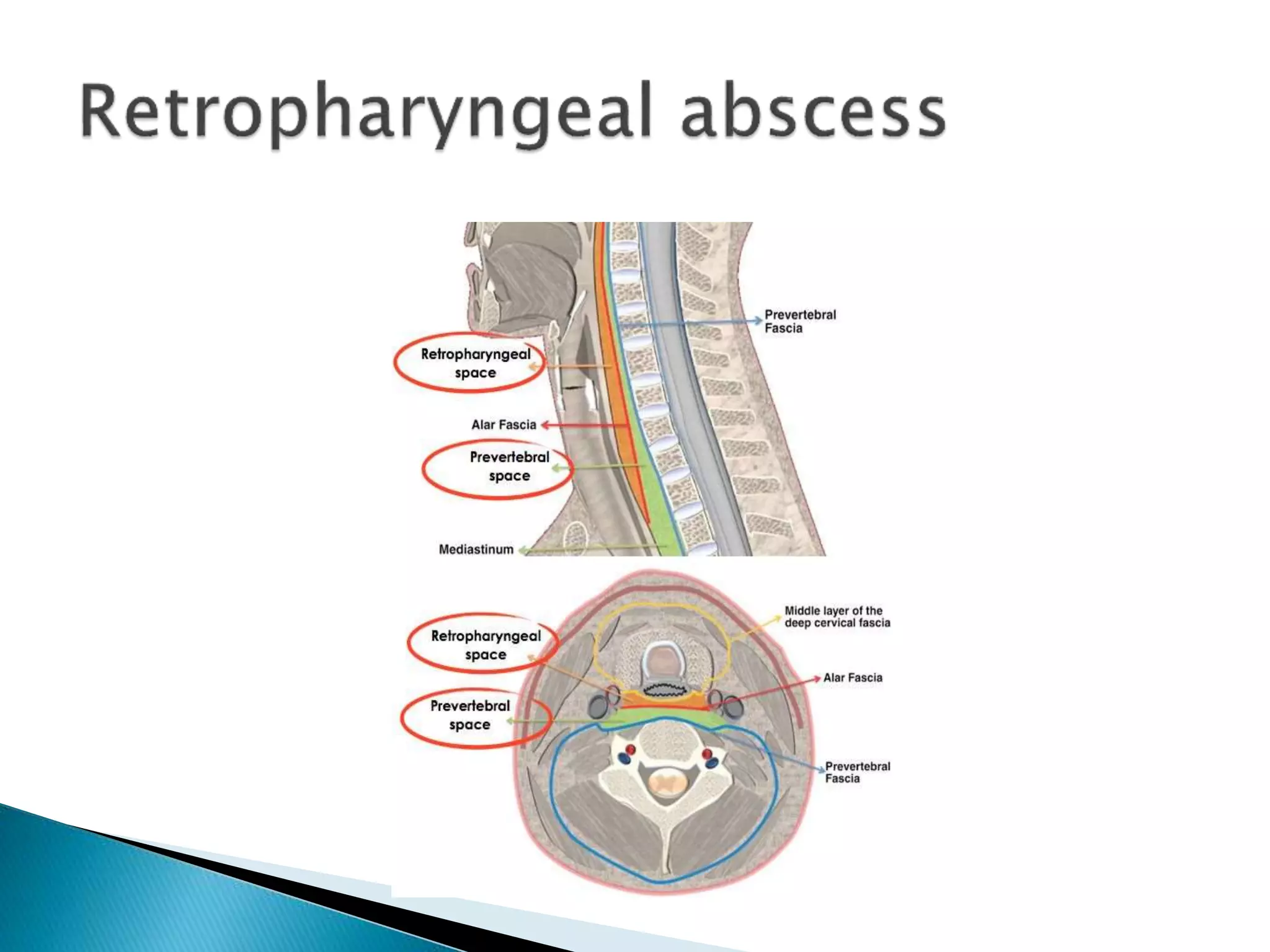 Head and neck space infections 22 8-2016,dr.bini mohan | PPTX
