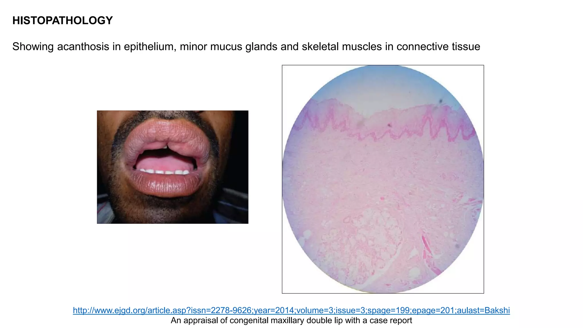 Syndrome / Head and Neck Syndrome | PPTX