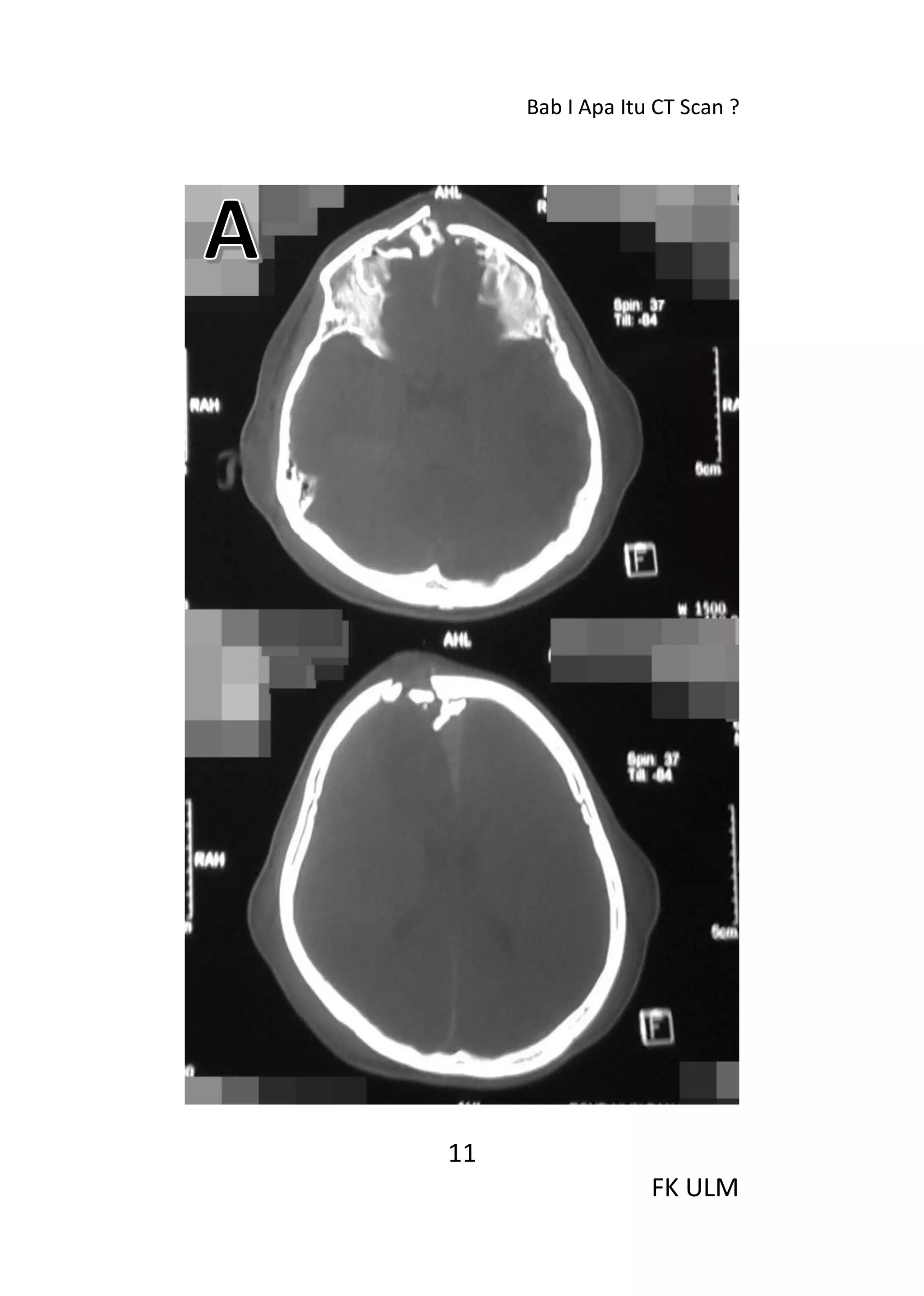 Head ct scan yusriandi ramadhan | PDF