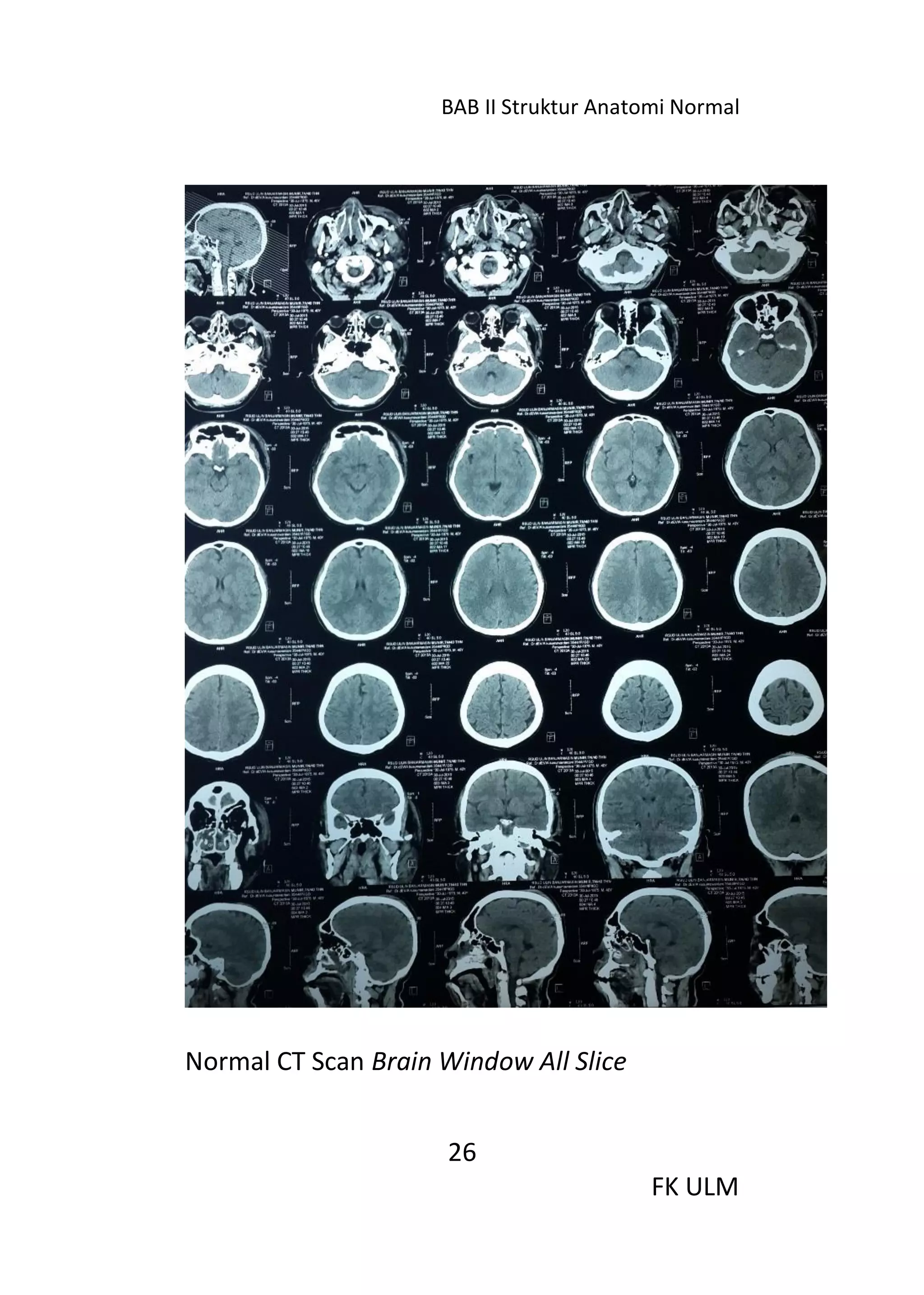 Head ct scan yusriandi ramadhan | PDF