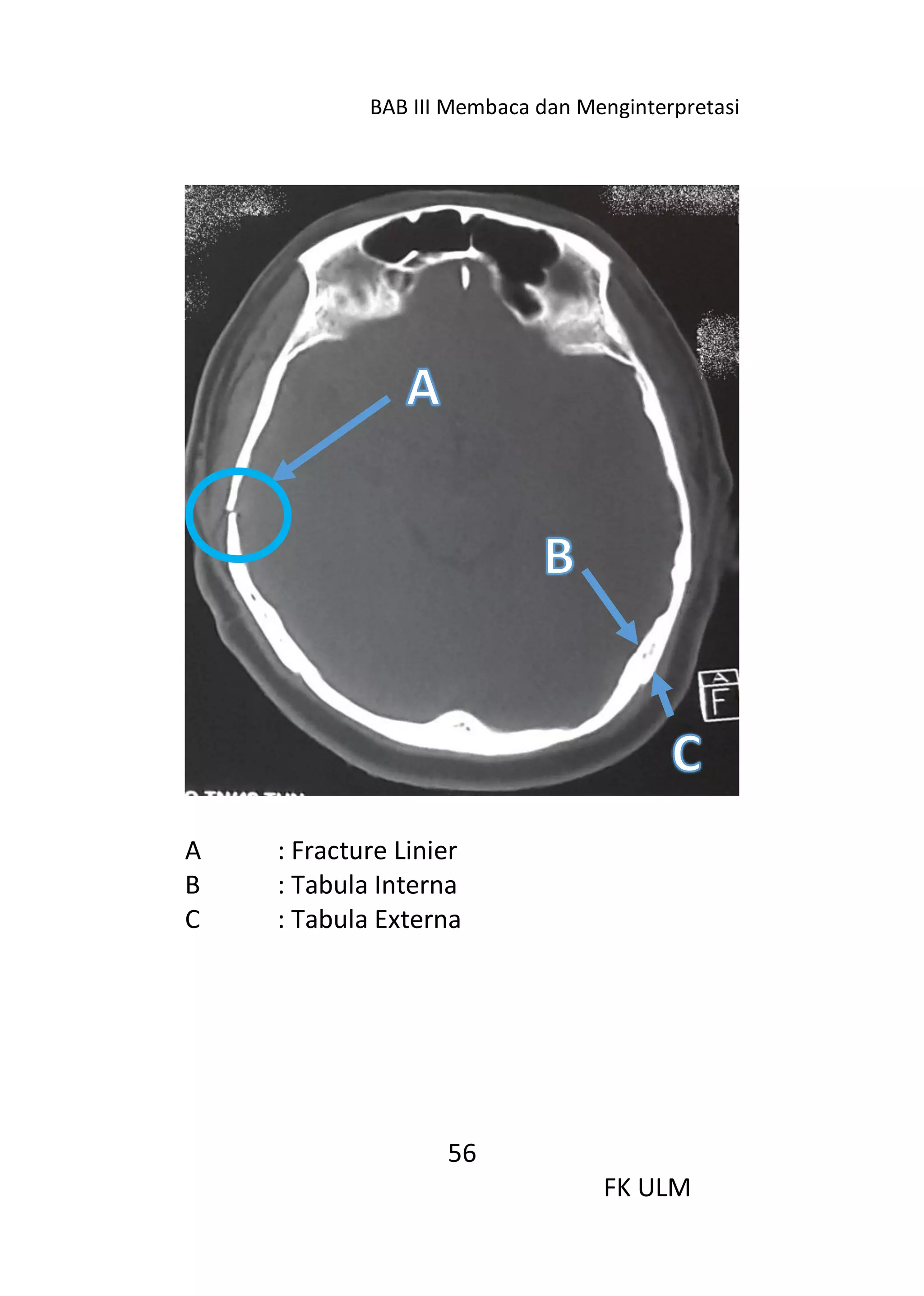 Head ct scan yusriandi ramadhan | PDF