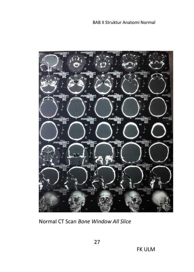 Head ct scan yusriandi ramadhan | PDF