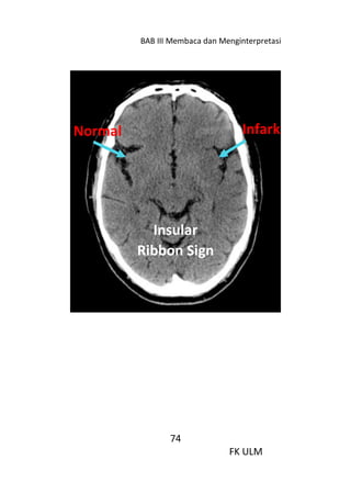 Head ct scan yusriandi ramadhan | PDF
