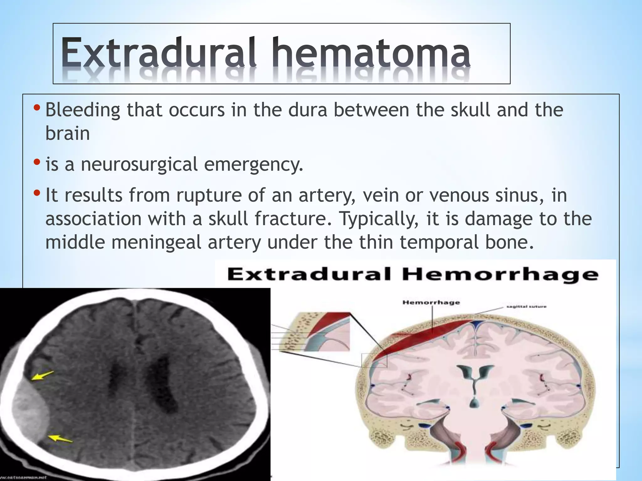 Head fractures & ;extradural hematoma | PPTX