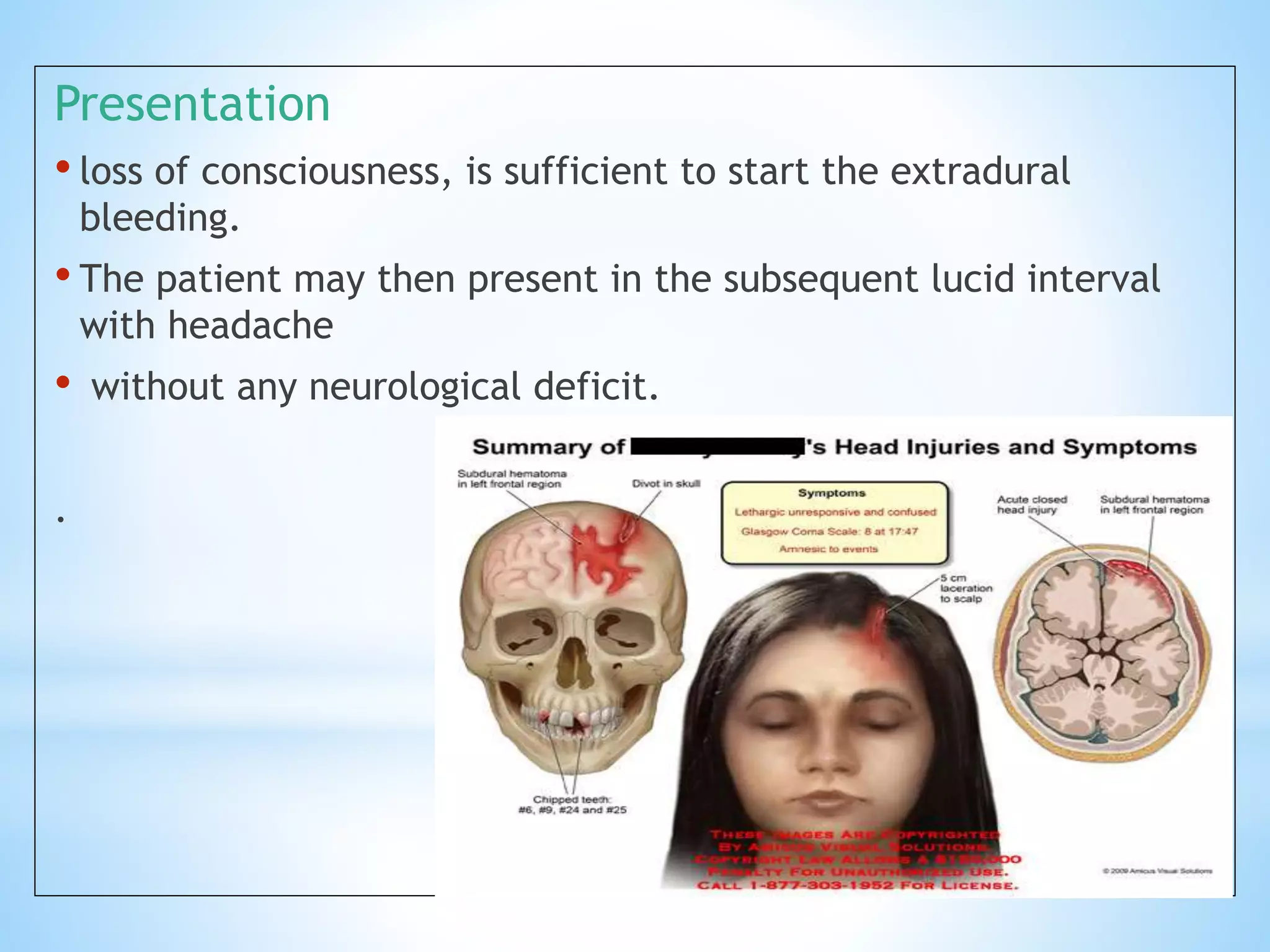 Head fractures & ;extradural hematoma | PPTX