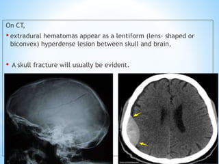 Head fractures & ;extradural hematoma | PPT