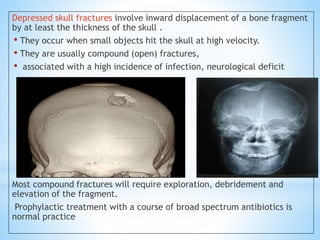 Head fractures & ;extradural hematoma | PPTX