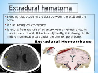 Head fractures & ;extradural hematoma | PPTX