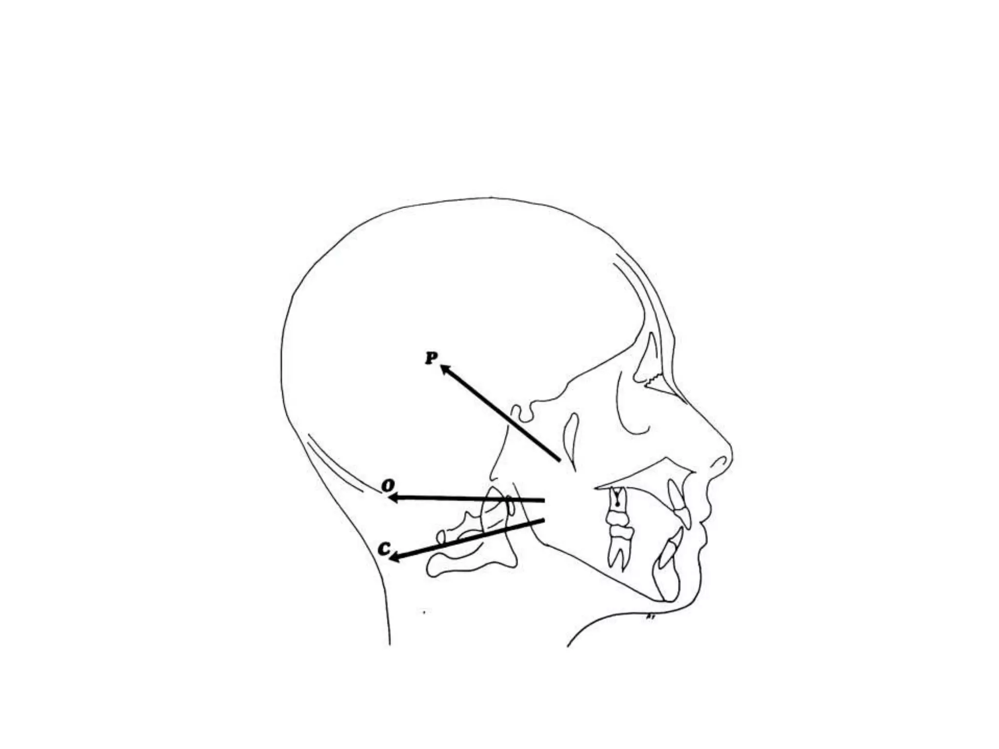 Head gear in orthodontics | PPTX