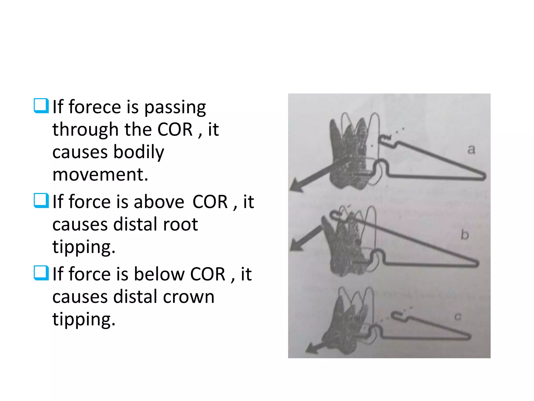 Head gear in orthodontics | PPTX