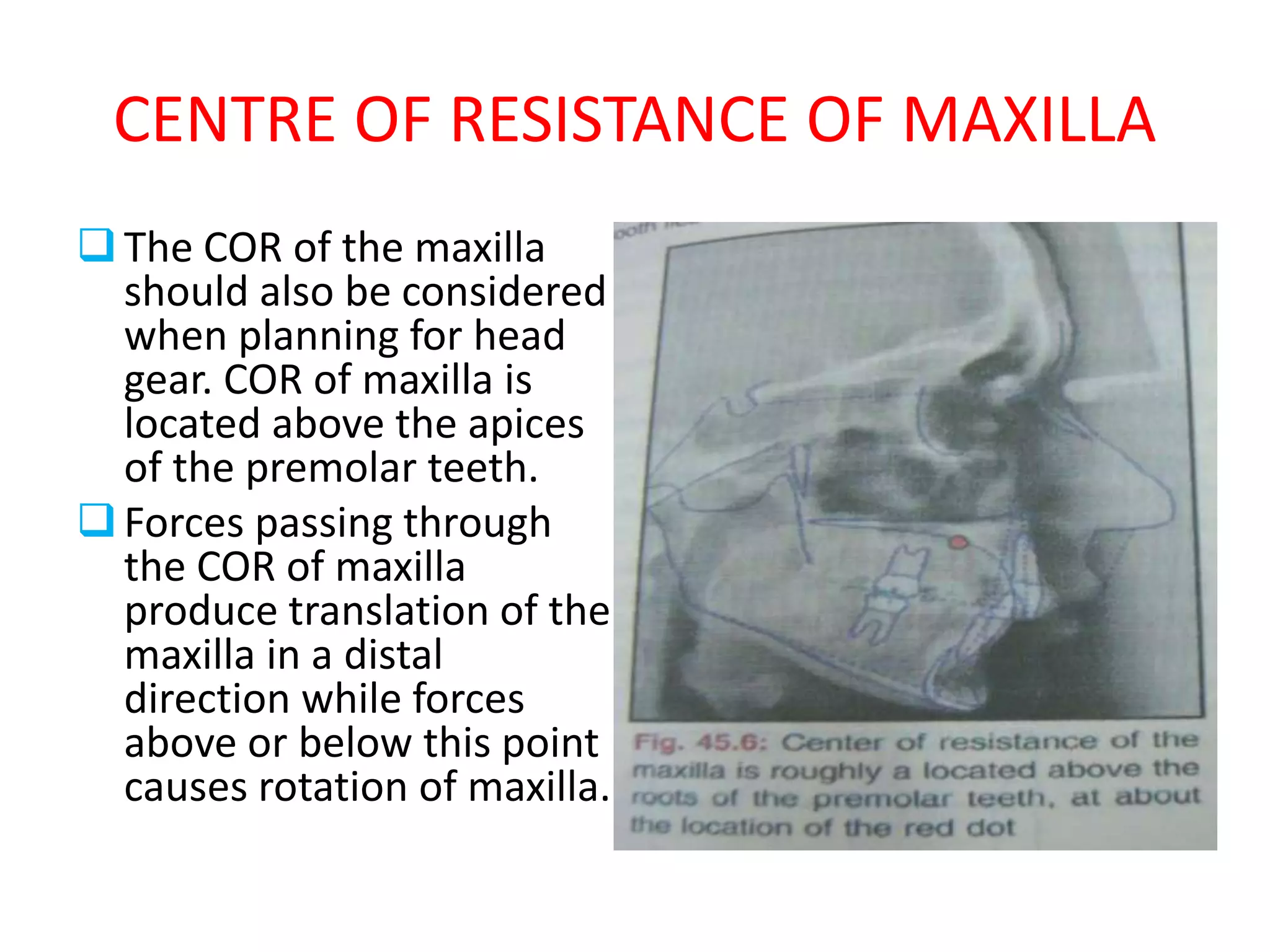 Head gear in orthodontics | PPTX